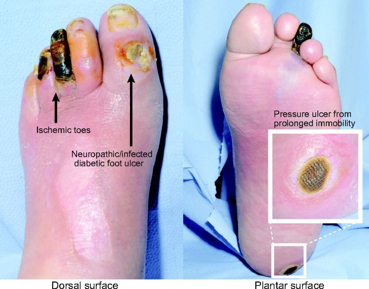 GLUCOBAN [IT] | ADC